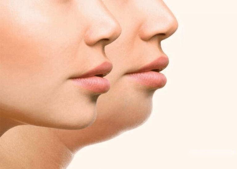 Double Jaw Surgery - Surgyteam