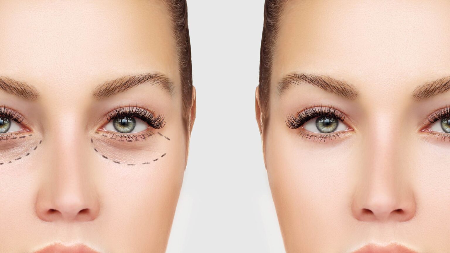 Lower Blepharoplasty - Surgyteam