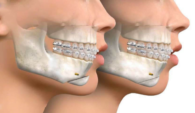 Orthognatic Surgery - Surgyteam
